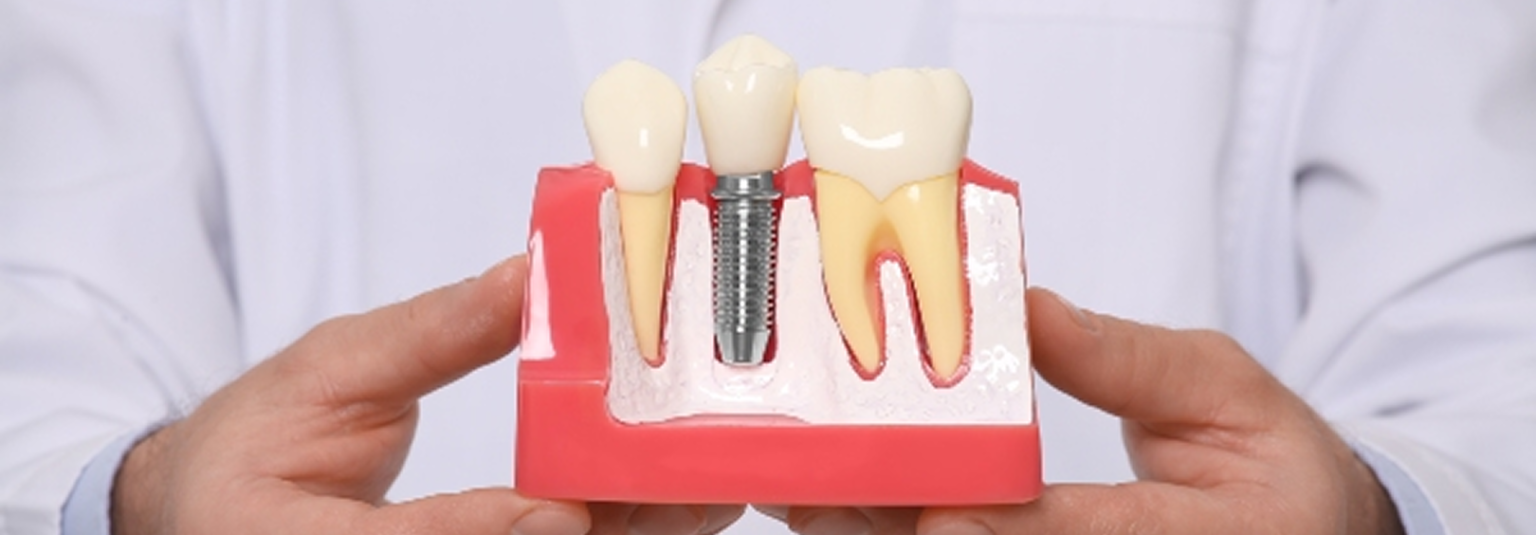 Single Tooth Dental Implants - ID Dental