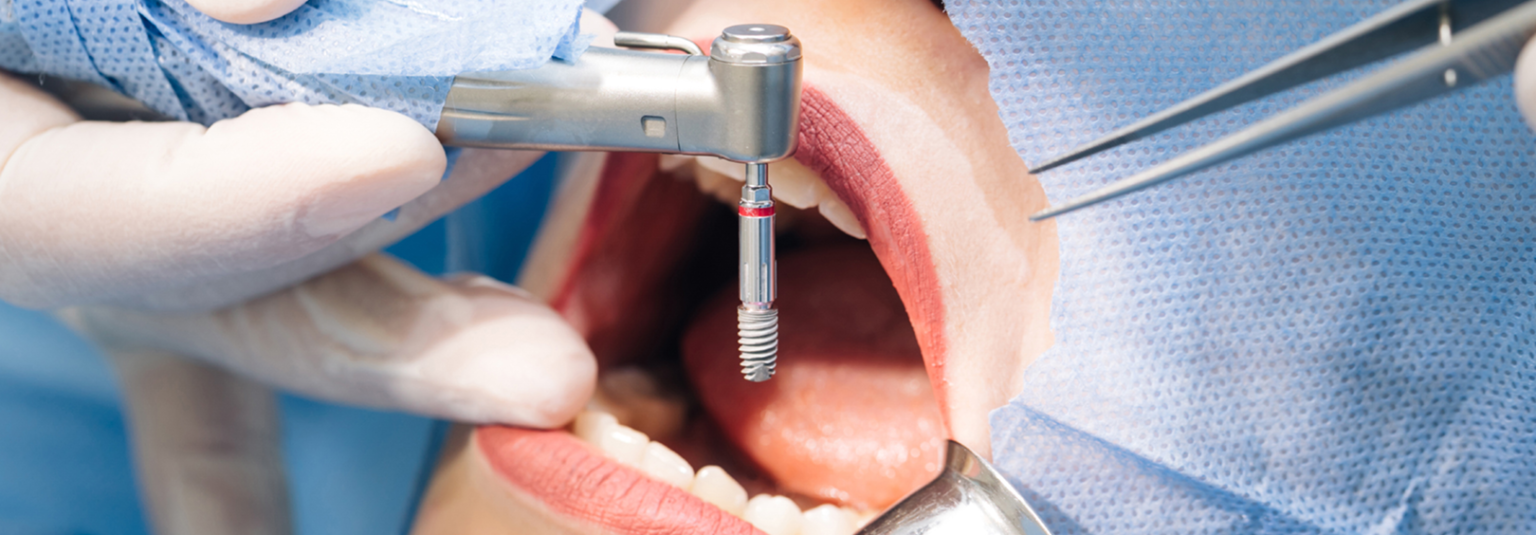 Single Tooth Dental Implants - ID Dental
