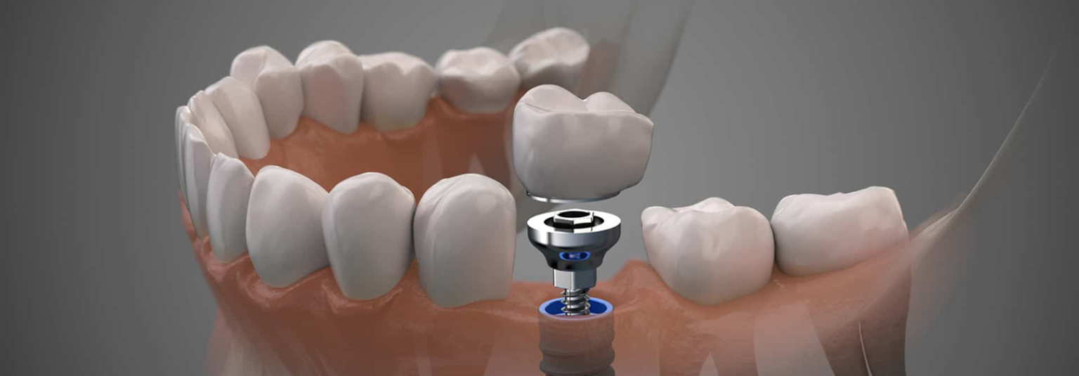 Single Tooth Dental Implants - ID Dental